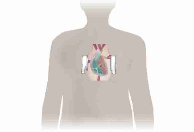 Options de traitement - Comprendre la sténose aortique