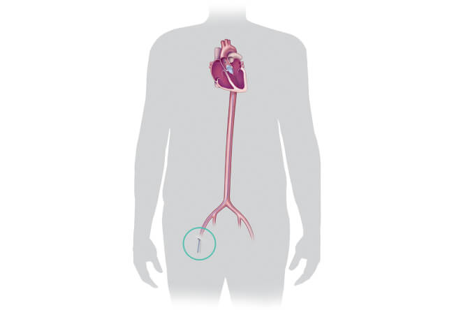 Options de traitement - Comprendre la sténose aortique